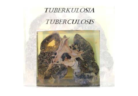 E_20160404 Expo Tuberculosis - Campusa - EHU